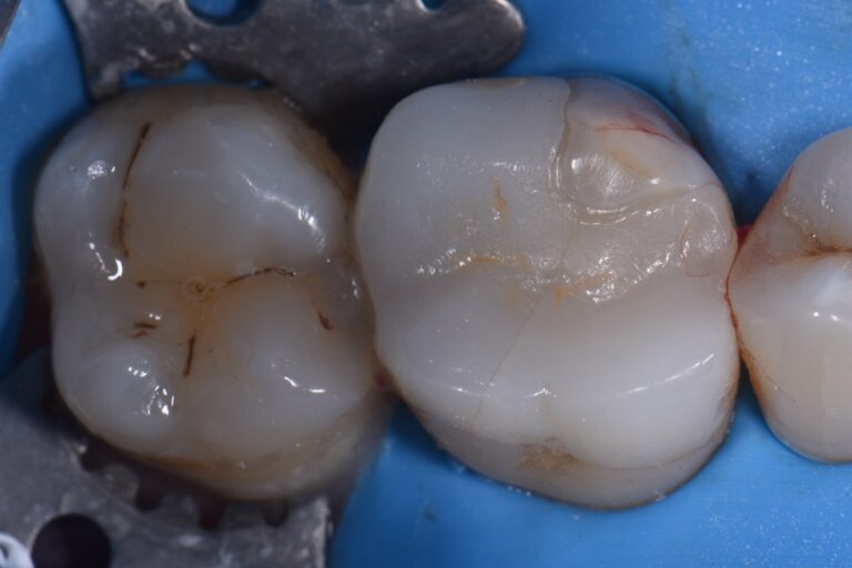 Bonded Dental Crowns Bonded Dental Crowns