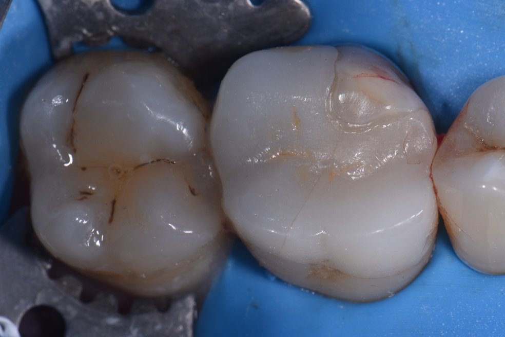 Bonded Dental Crowns Bonded Dental Crowns