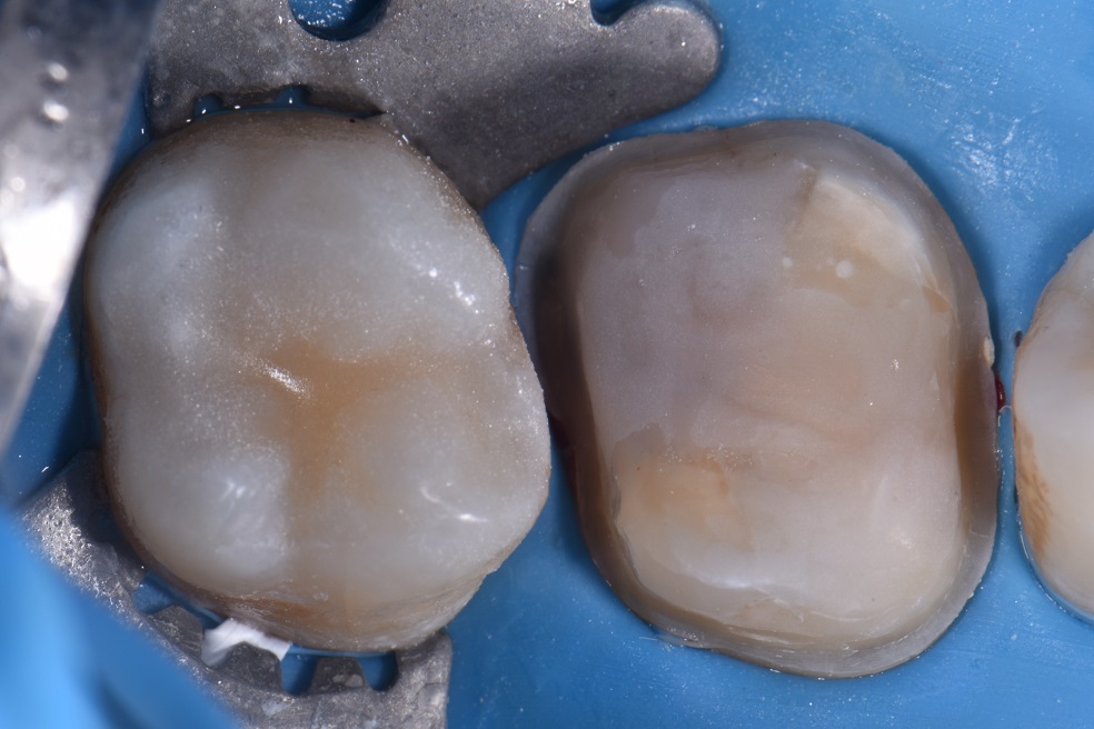 Bonded Dental Crowns Bonded Dental Crowns