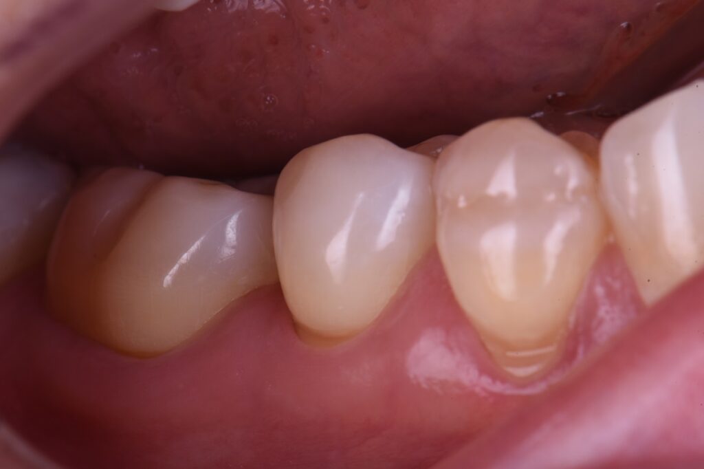 Milled toothbrush abrasion lesions reversed