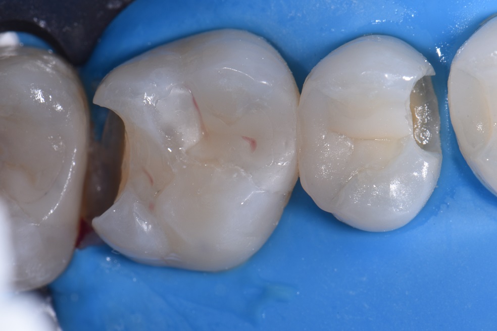 Slot prep and restorations Slot prep and restorations