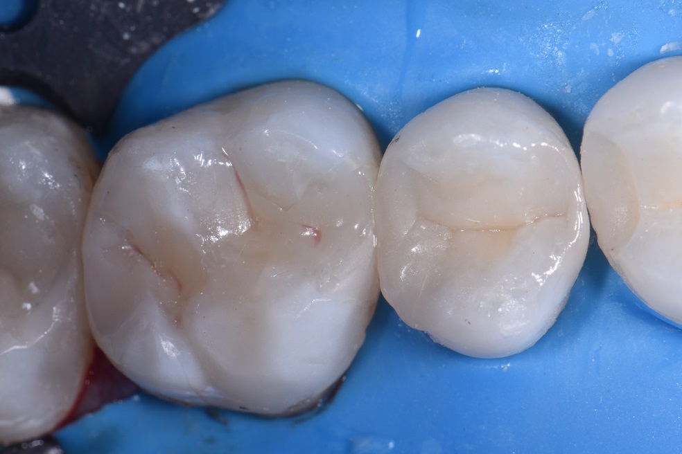 Slot prep and restorations Slot prep and restorations