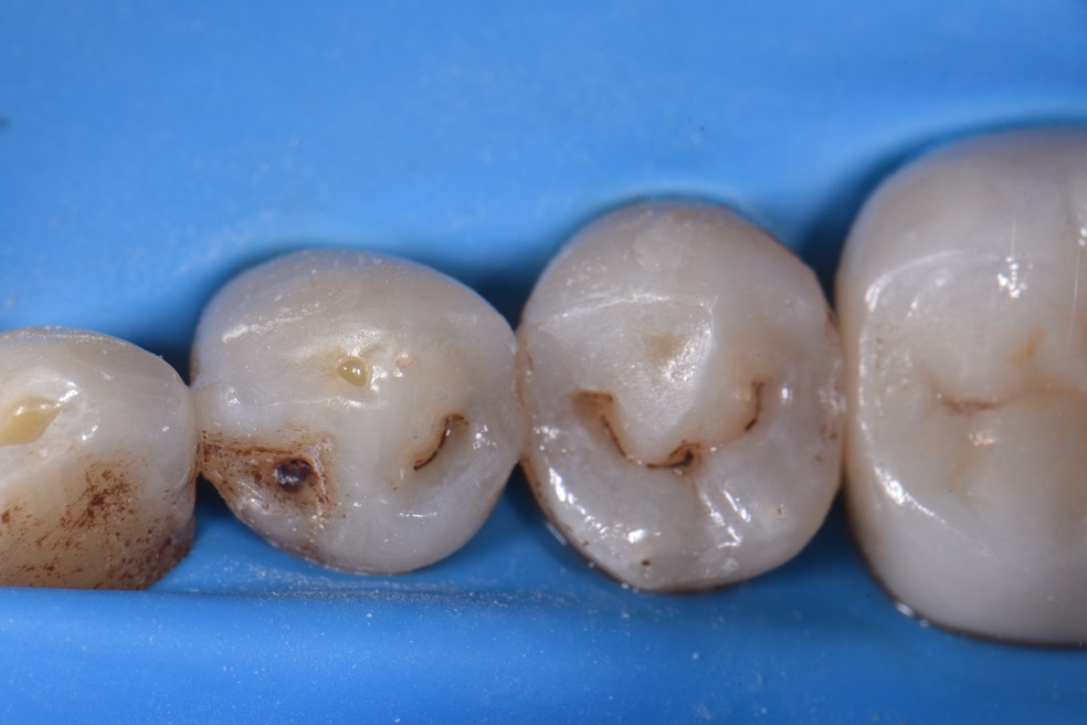 Slot Prep Composite Restorations Slot Prep Composite Restorations