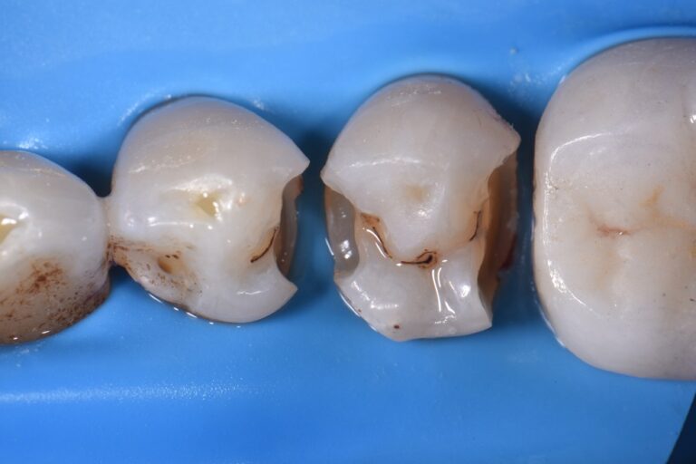 Slot Prep Composite Restorations Slot Prep Composite Restorations