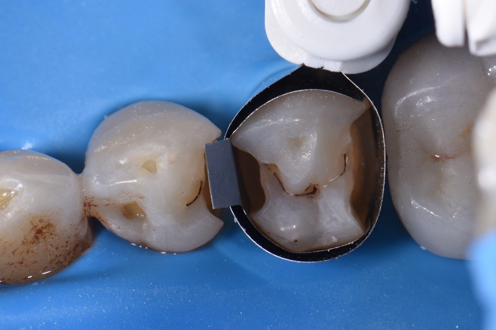 Slot Prep Composite Restorations Slot Prep Composite Restorations