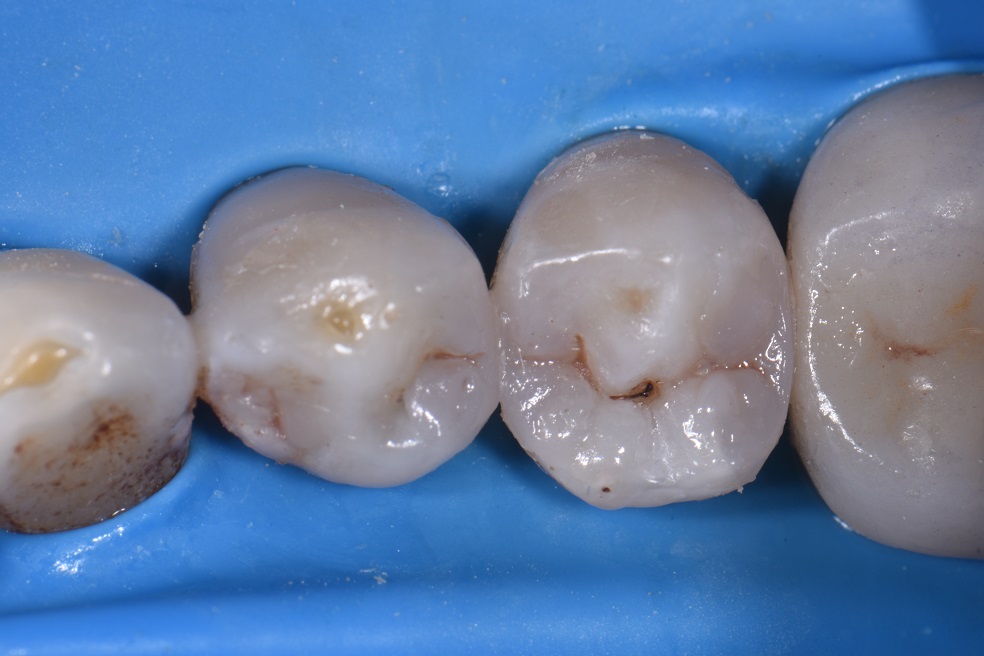 Slot Prep Composite Restorations Slot Prep Composite Restorations