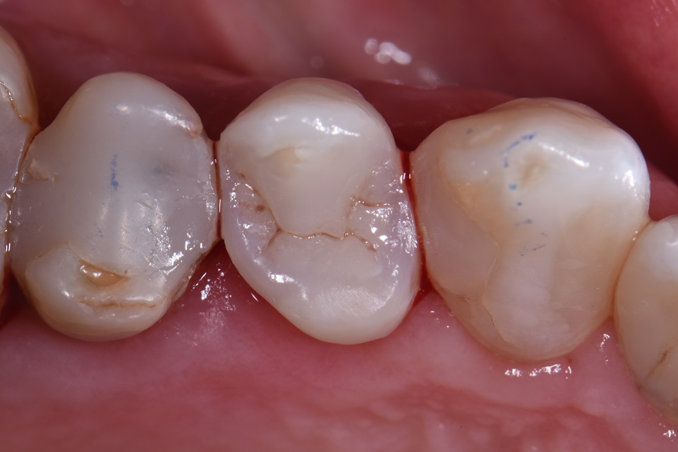 Direct Composite Reconstruction Direct Composite Reconstruction