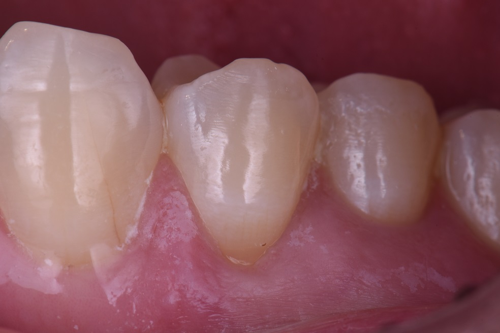 Cervical Abrasion Lesions Cervical Abrasion Lesions