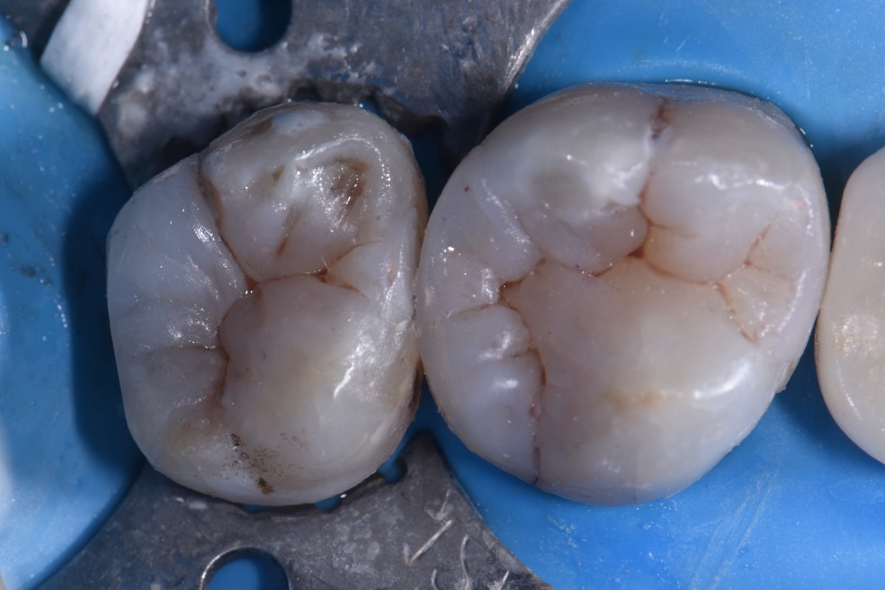 Amalgam Removal and Reconstruction with Composite Amalgam Removal and ...