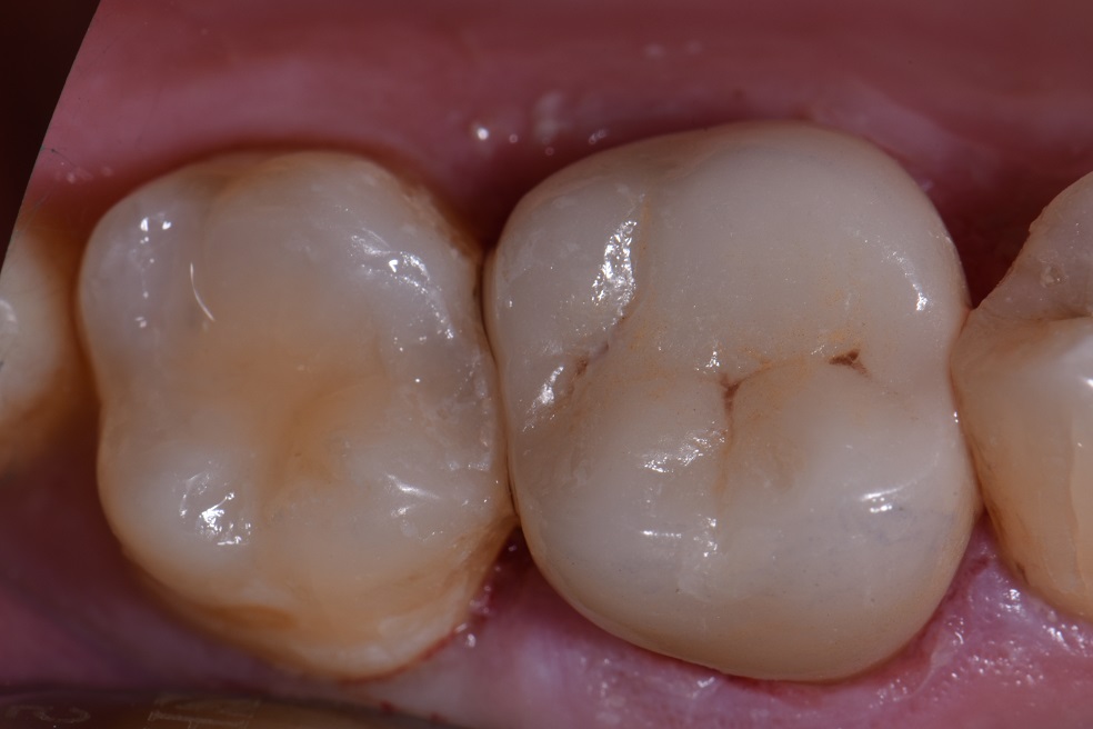 Bonded Dental Crowns Bonded Dental Crowns