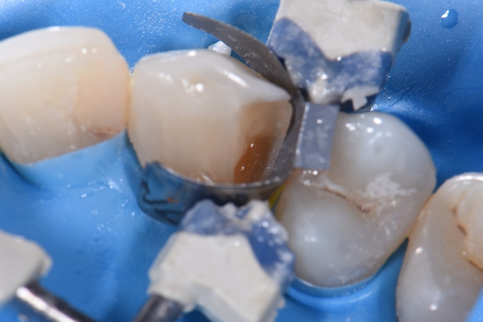 Contour addition teeth Addition of Contour to existing restorations