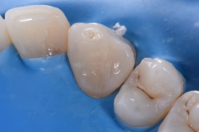 Contour addition teeth Addition of Contour to existing restorations