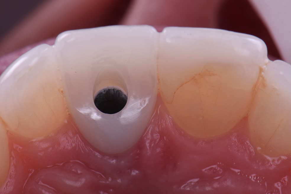 Matching an Implant to a Veneer Matching an Implant to a Veneer
