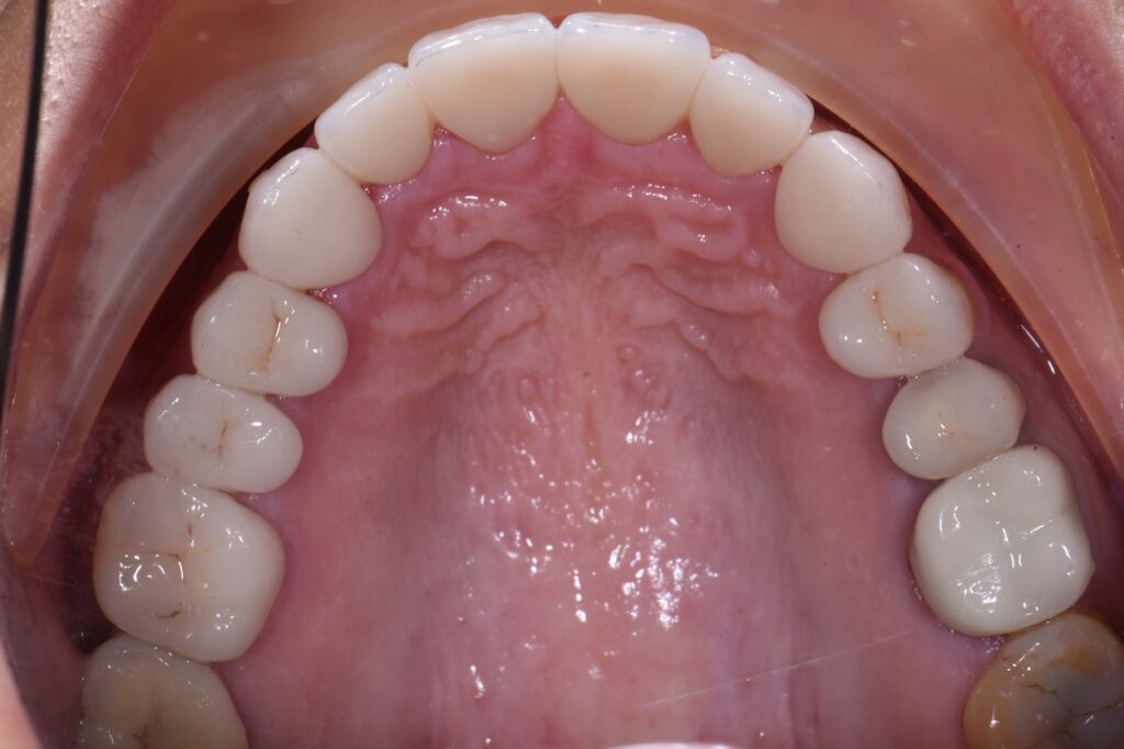 Occlusal rejuvenation and dental structural support