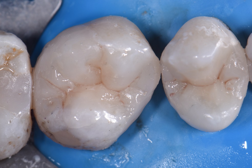 Closing posterior large spaces with composite resin Closing posterior ...