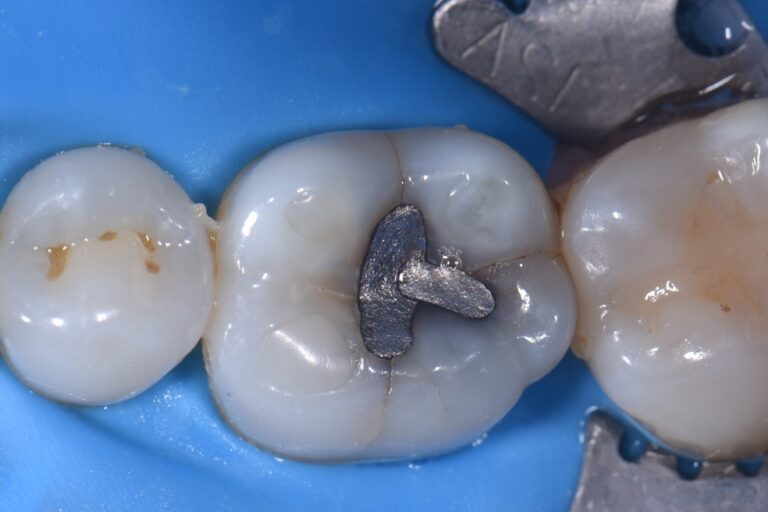 Peripheral Rim Fractures Peripheral Rim Fractures