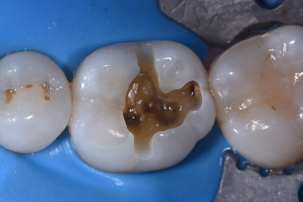 Peripheral Rim Fractures Peripheral Rim Fractures