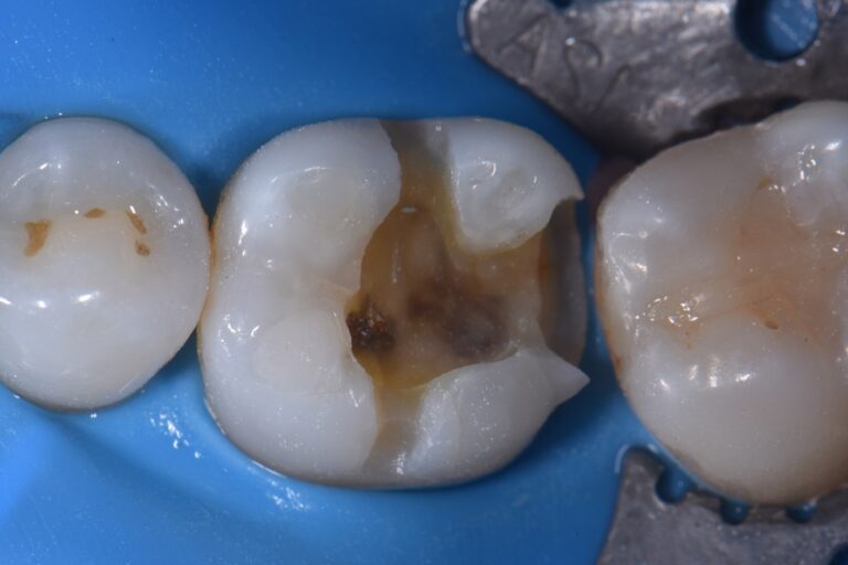 Peripheral Rim Fractures Peripheral Rim Fractures