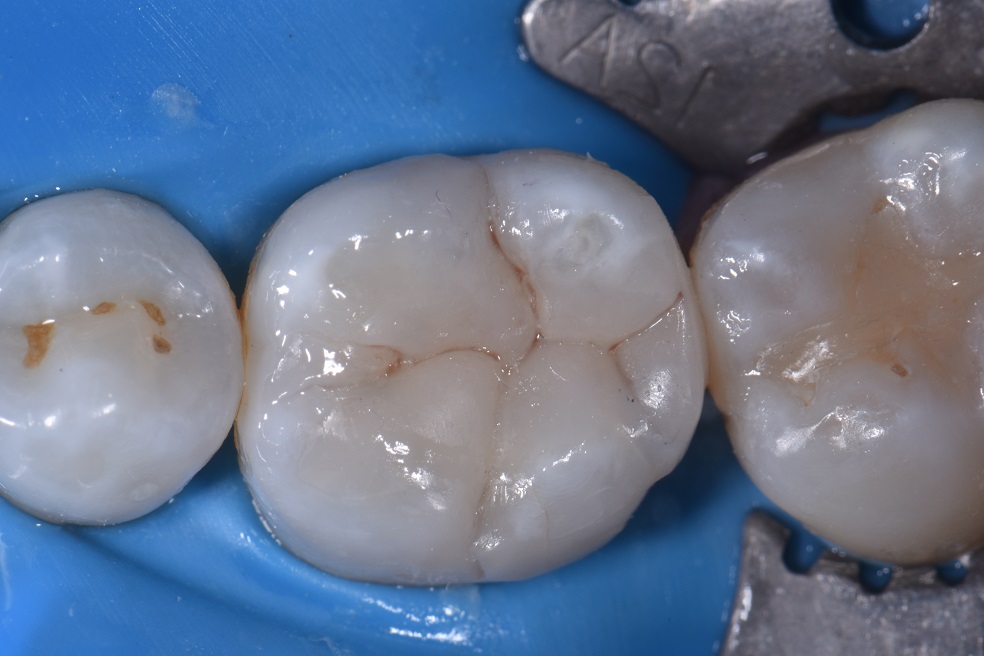 Peripheral Rim Fractures Peripheral Rim Fractures