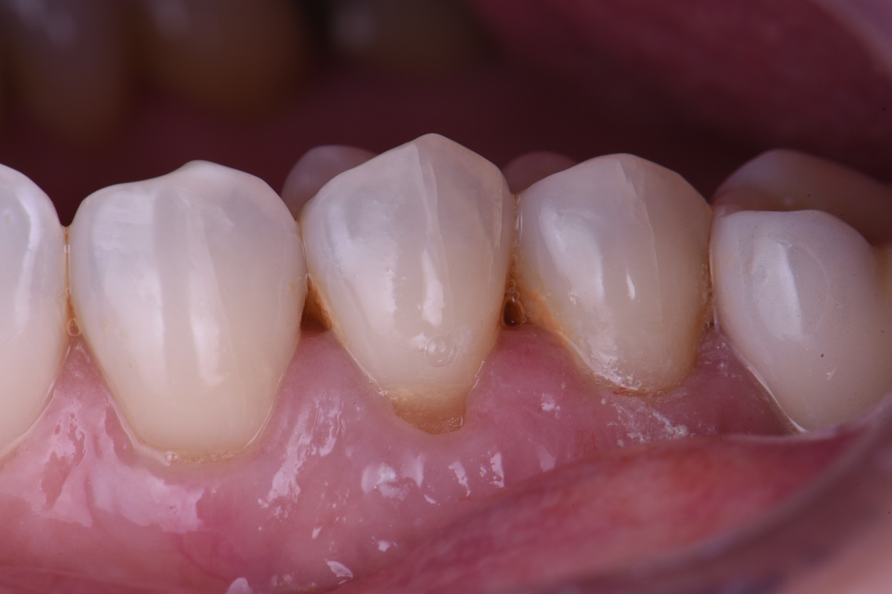 Root Cavities and Restoration Variation Root Cavities and Restoration ...