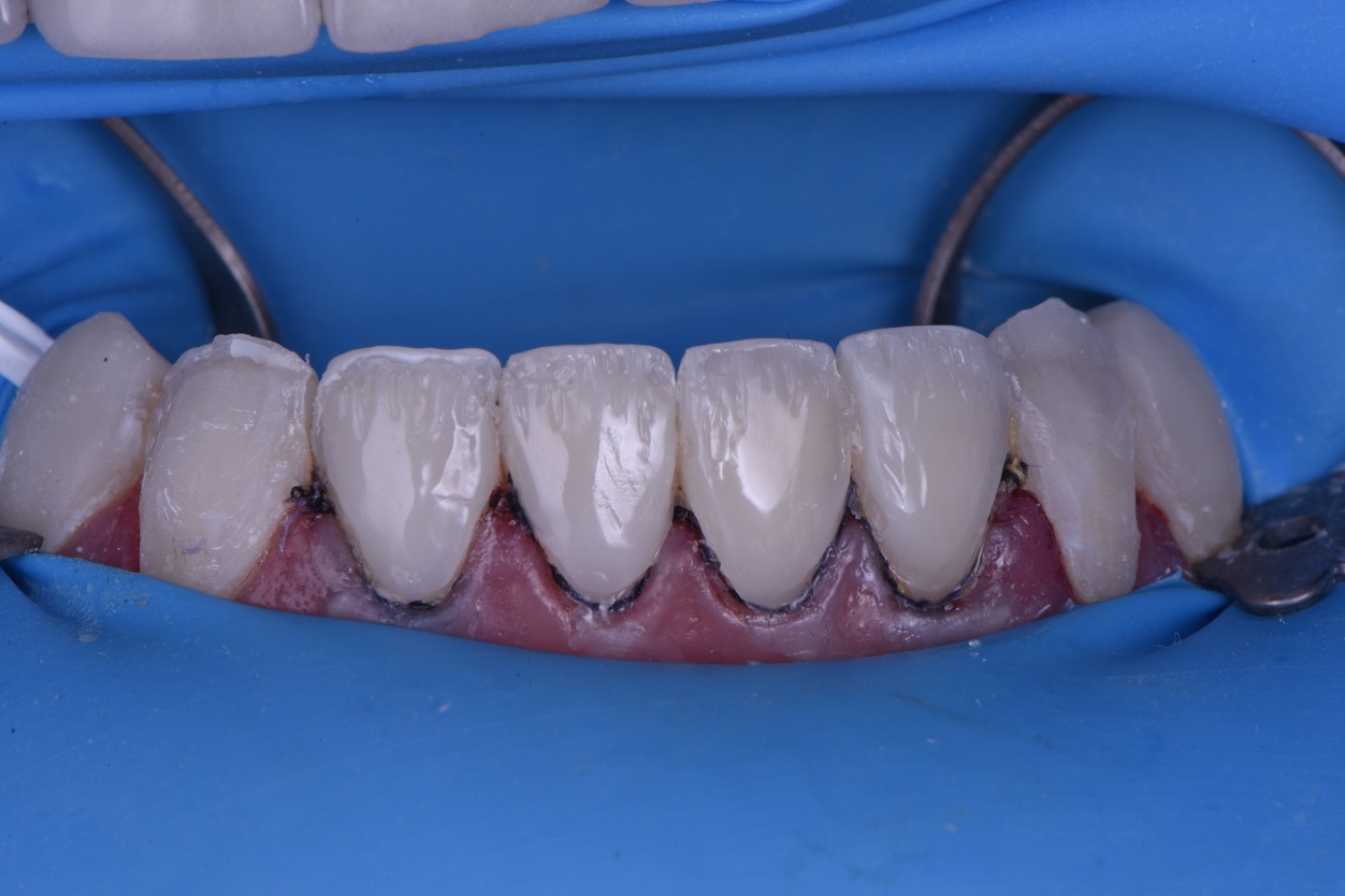 Relayering of Injectable Composite for Ultimate Esthetics Relayering of ...