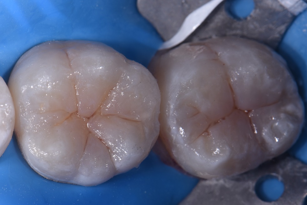 Micro sculpted dental composite fillings Micro sculpted dental ...