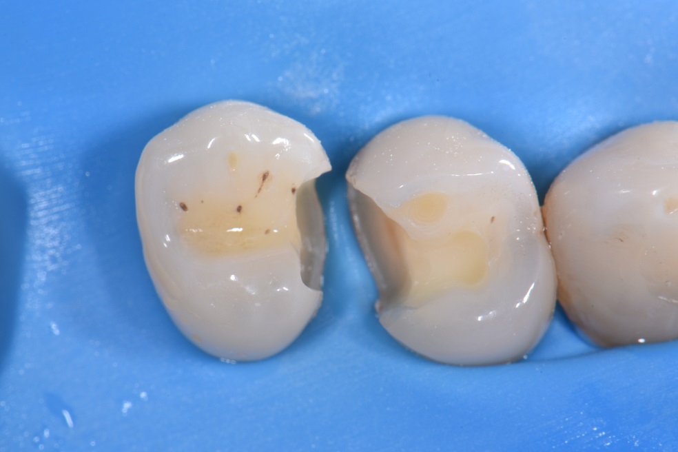 Back to Back Premolar Restorations Back to Back Premolar Restorations