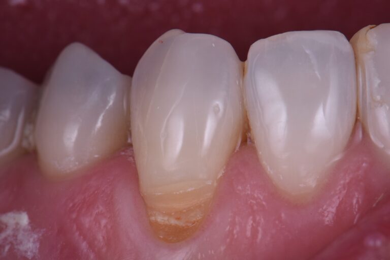 Restoring Dental Abrasions Restoring Dental Abrasions