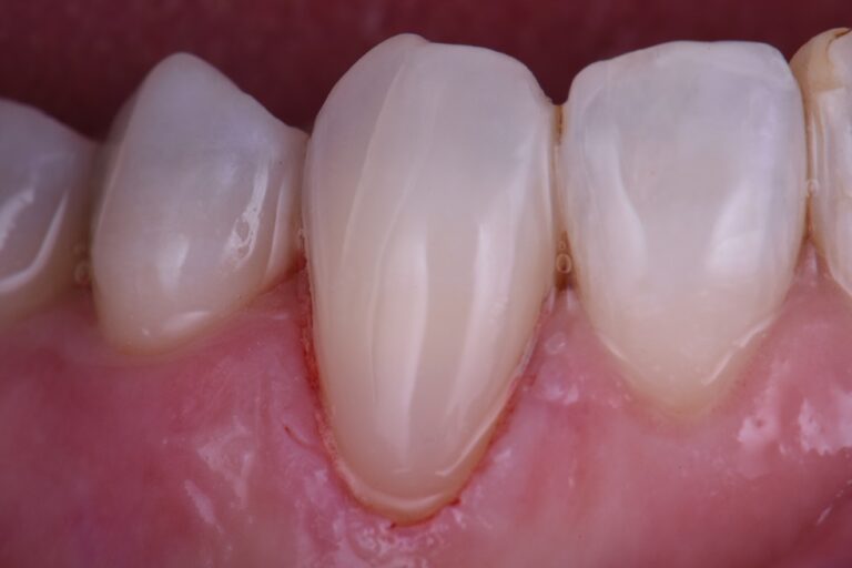 Restoring Dental Abrasions Restoring Dental Abrasions