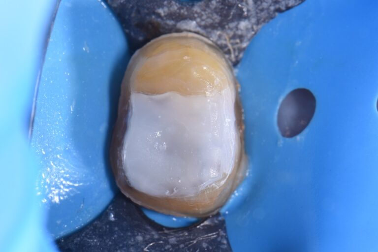 Dental Crowns Onlays and Overlays Dental Crowns Onlays and Overlays