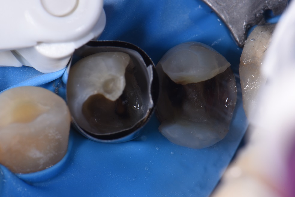 Extensive Dental Composite Restorations Extensive Dental Composite ...