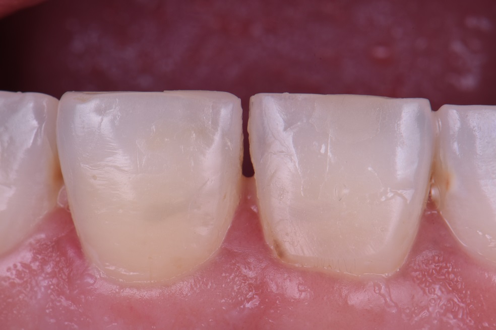 Resurfacing Old Composite Restorations Resurfacing Old Composite ...
