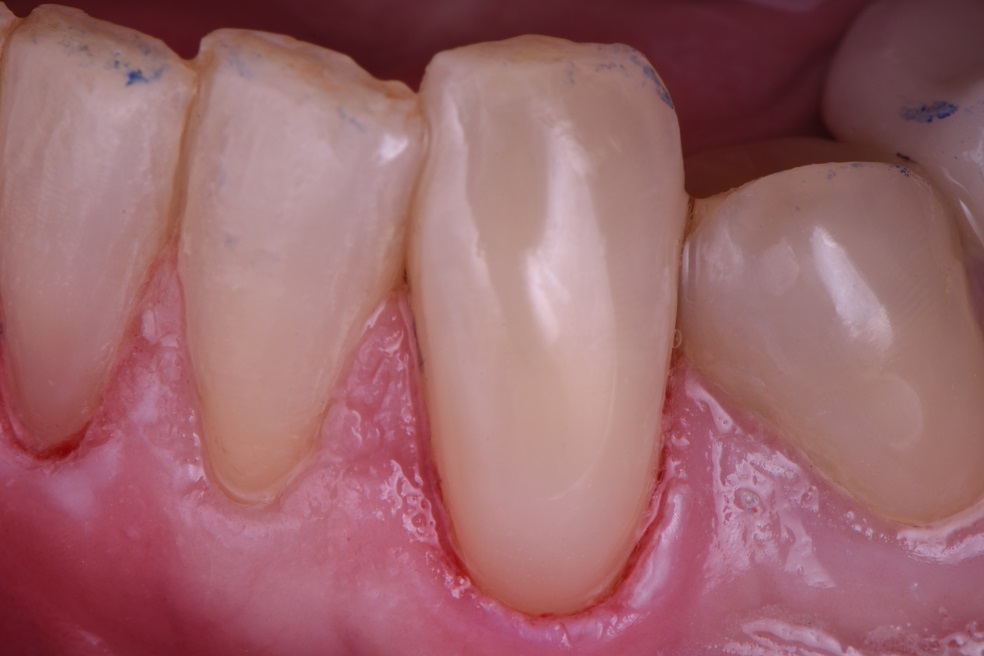 Recurrent cervical abrasion Recurrent cervical abrasion
