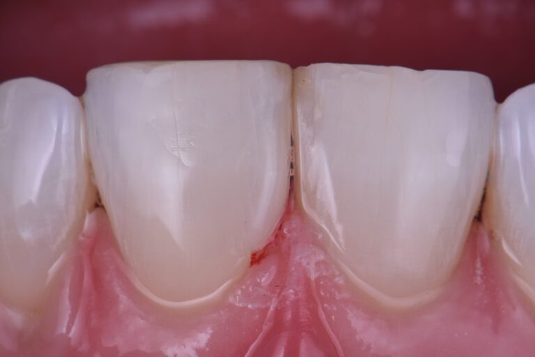 Replacing a black triangle composite restoration