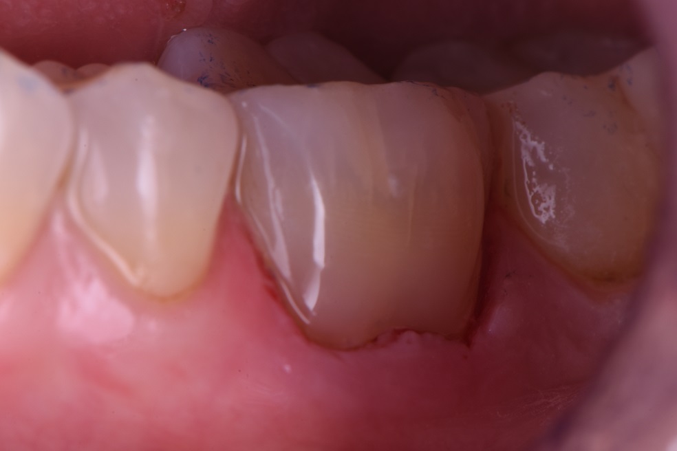 Relative Dentin Abrasivity Relative Dentin Abrasivity
