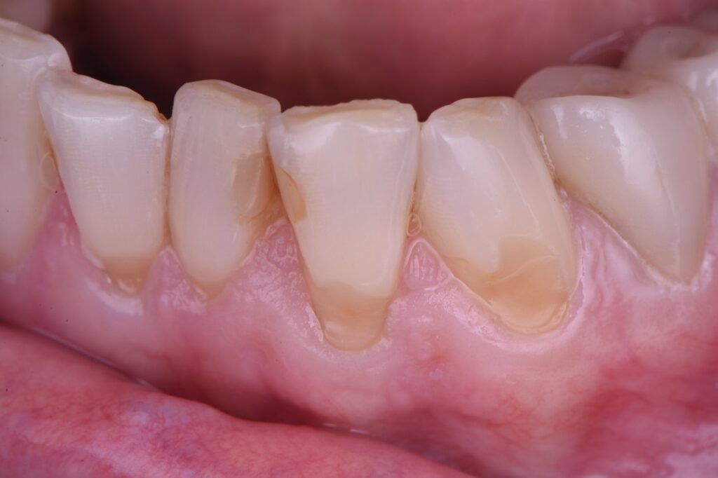 Class V Restorations