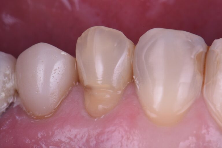 Large Cervical Abrasion and Abfraction Lesions