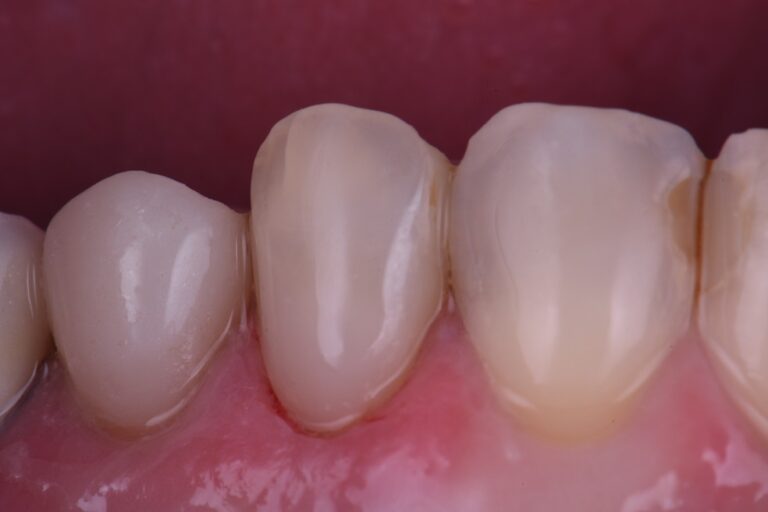 Large Cervical Abrasion and Abfraction Lesions