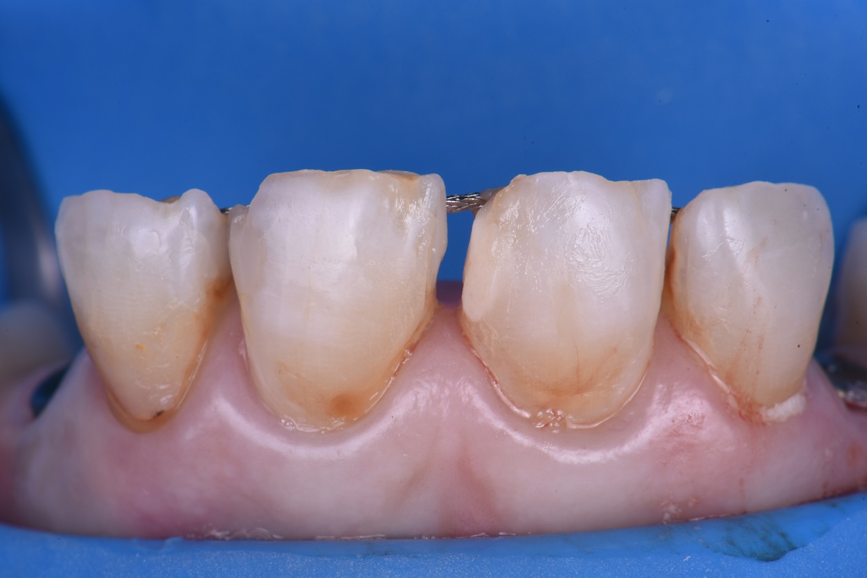 Changing Tooth Axial Angle Restoratively Changing Tooth Axial Angle ...