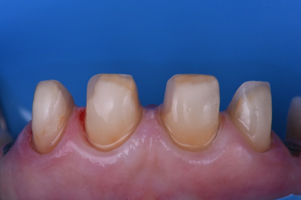 Changing Tooth Axial Angle Restoratively Changing Tooth Axial Angle ...