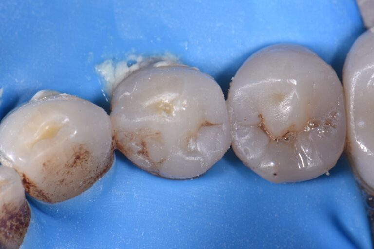 First Bicuspid Slot Restoration