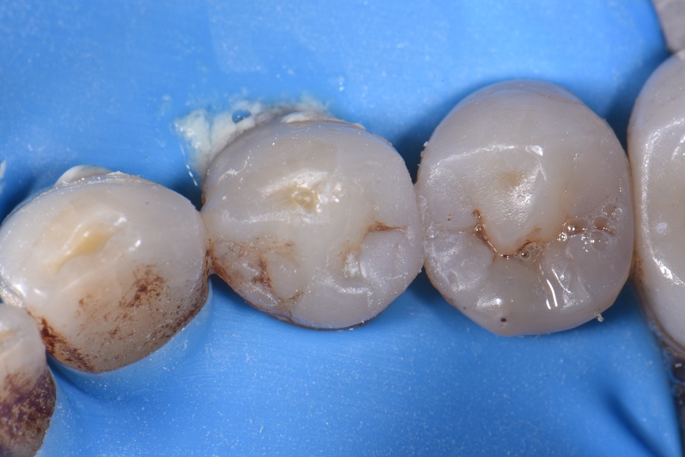 First Bicuspid Slot Restoration