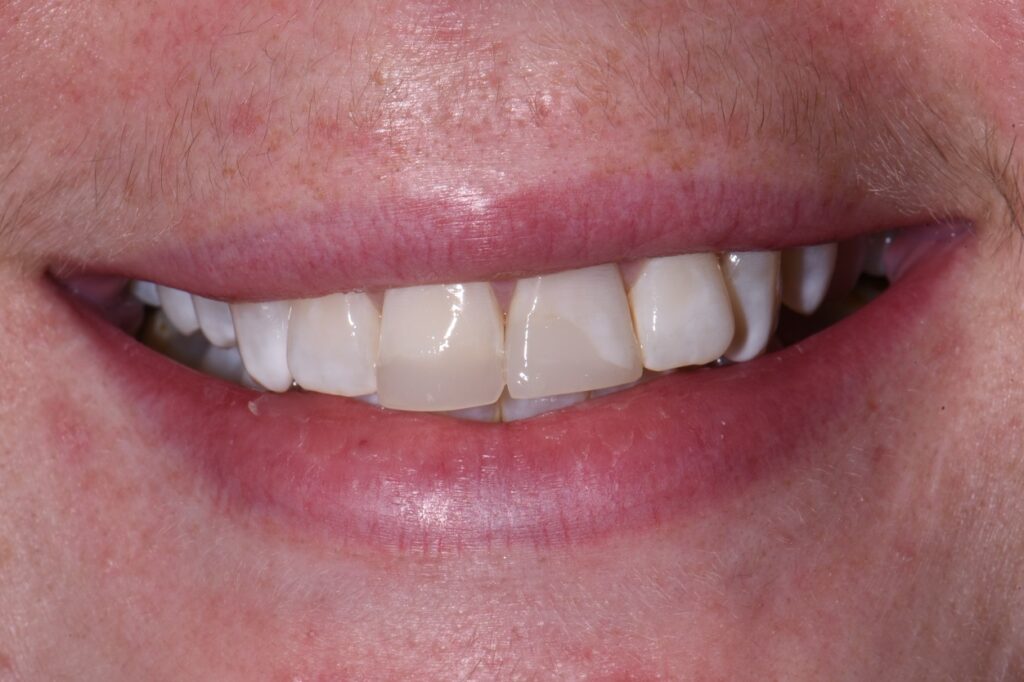 Dental Accident Repair Dental Accident Repair