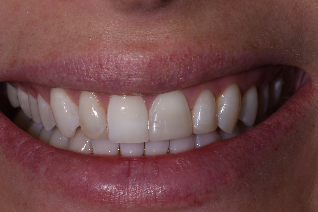 Composite Veneers to Balance Esthetics Composite Veneers to Balance ...