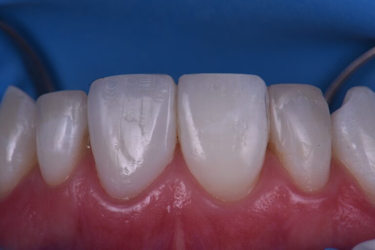 Peg lateral augmentation with composite veneers