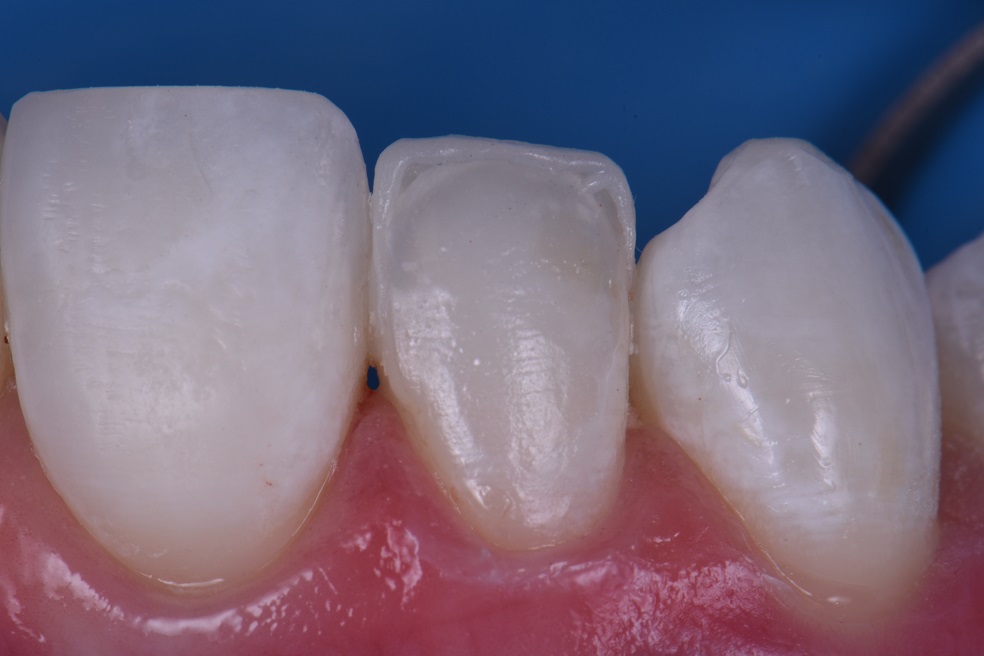 Peg lateral augmentation with composite veneers