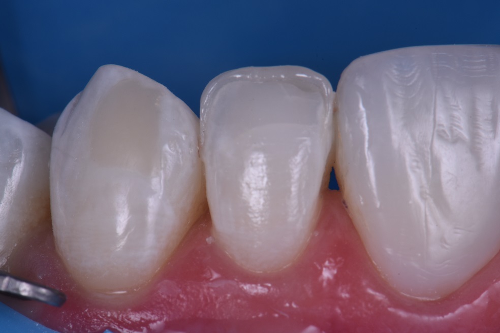 Peg lateral augmentation with composite veneers