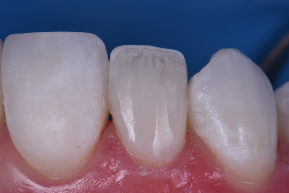 Peg lateral augmentation with composite veneers