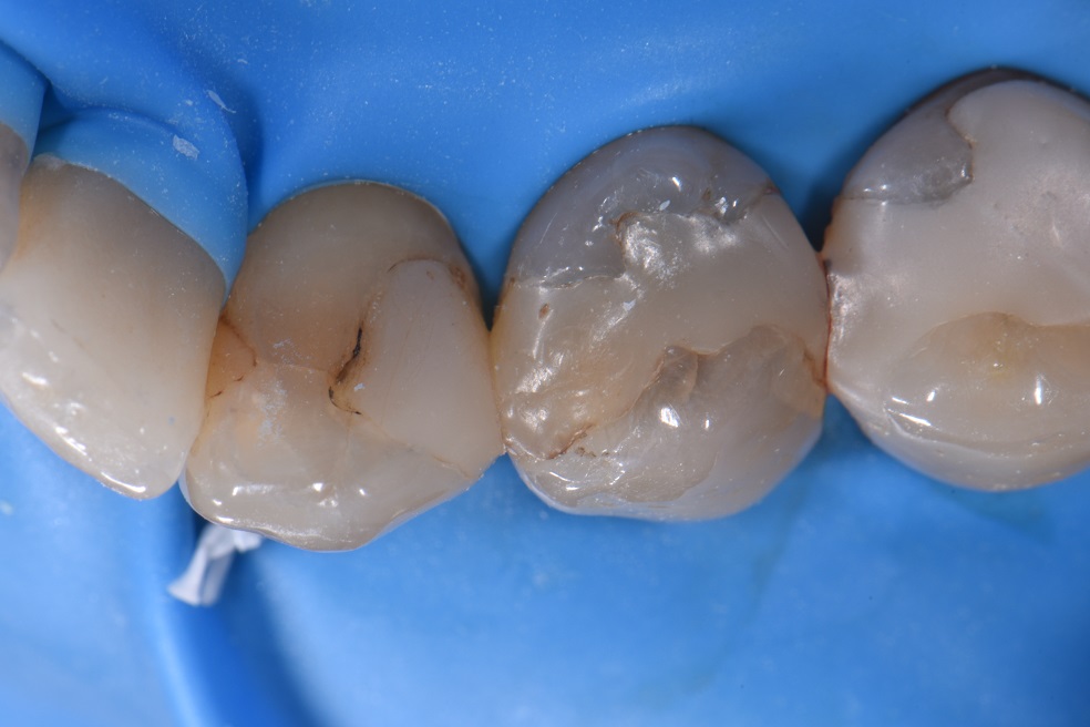Marginal leakage on old composite fillings