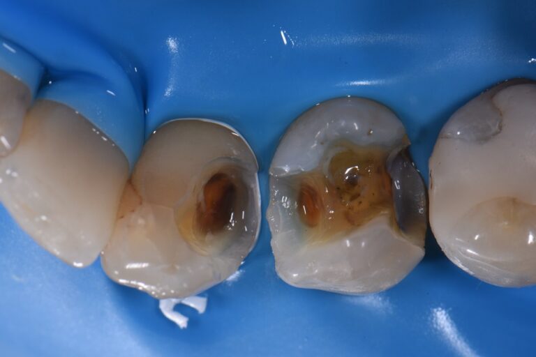Marginal leakage on old composite fillings